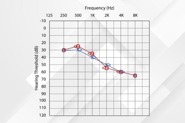 Complete Guide to Mixed Hearing Loss Causes and Symptoms - Ear Solutions